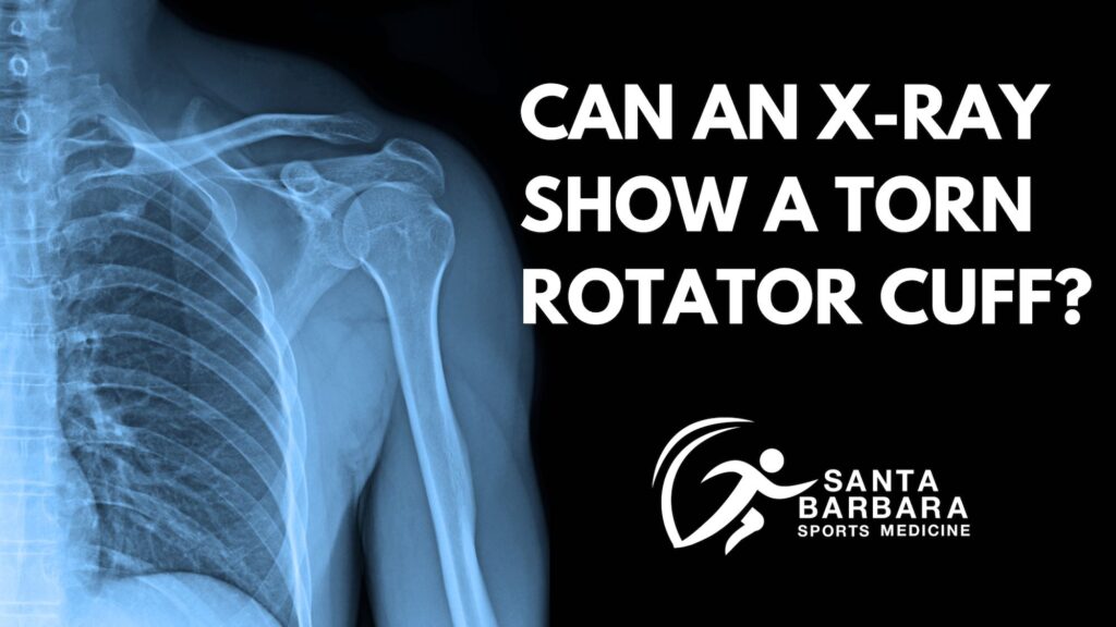 Can an X-Ray Show a Torn Rotator Cuff? – Dr. Amit Nathani, MD
